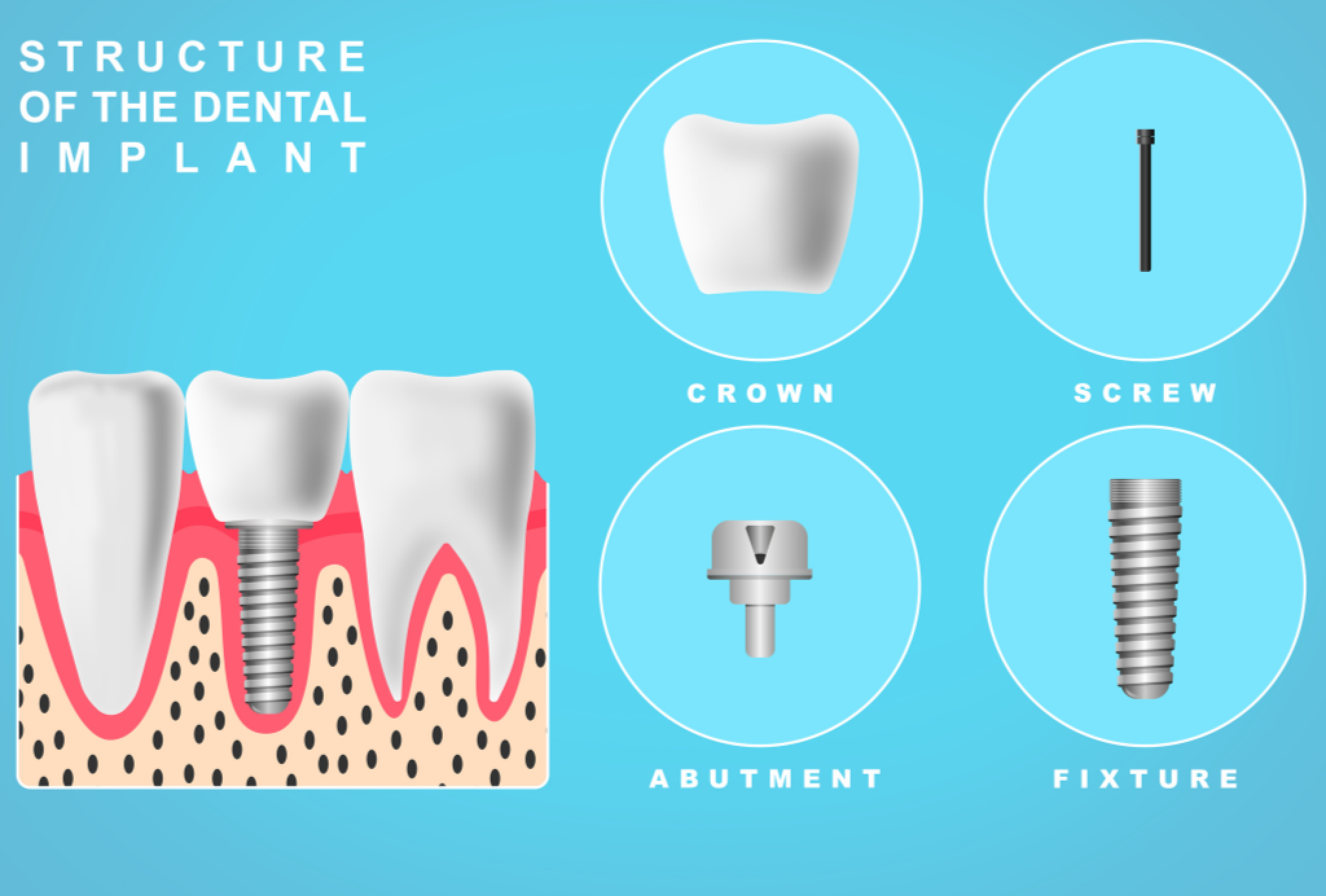Full Mouth Dental Implants Procedure